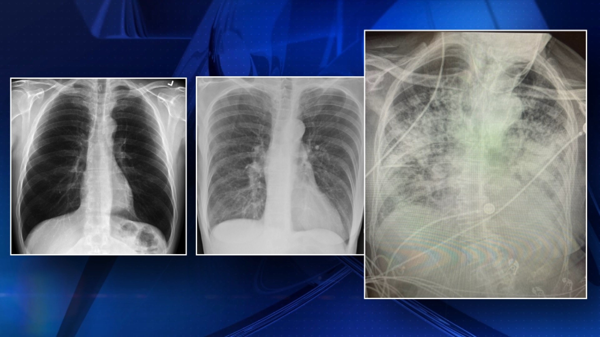 Rayos X De Los Pulmones De Fumar
